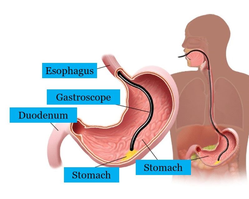 Gastroscopy In Singapore Andrea Digestive Gastroenterology Clinic
